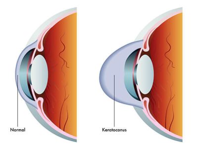 Keratoconus - Insight Vision Center Optometry