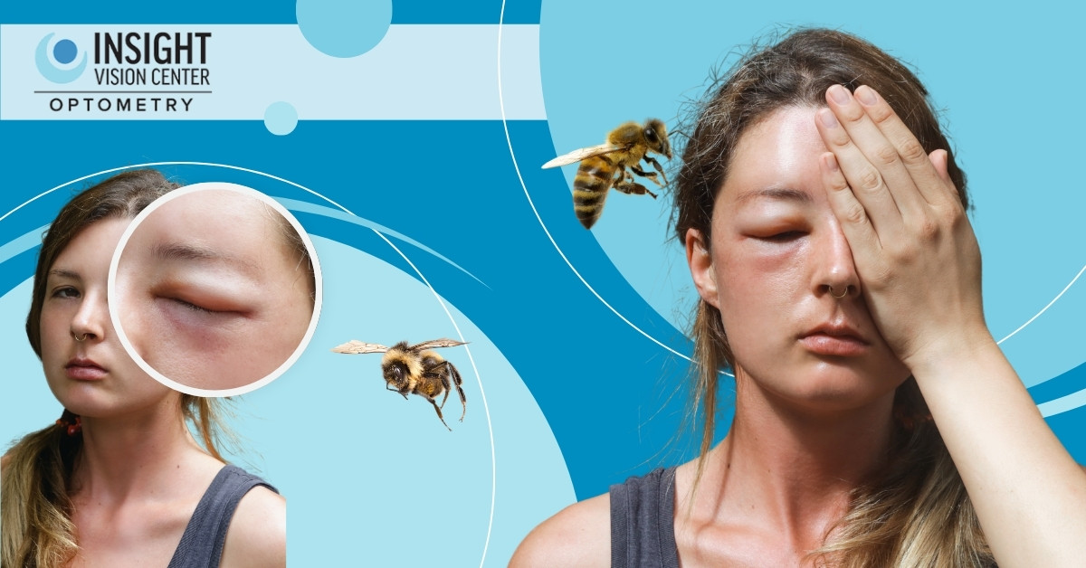 Introduction to Ocular Bee and Wasp Stings - Insight Vision Center Optometry