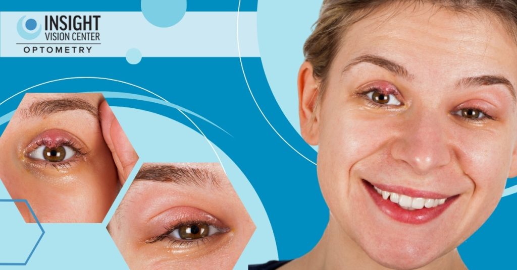 Understanding Styes and Chalazia - Insight Vision Center Optometry